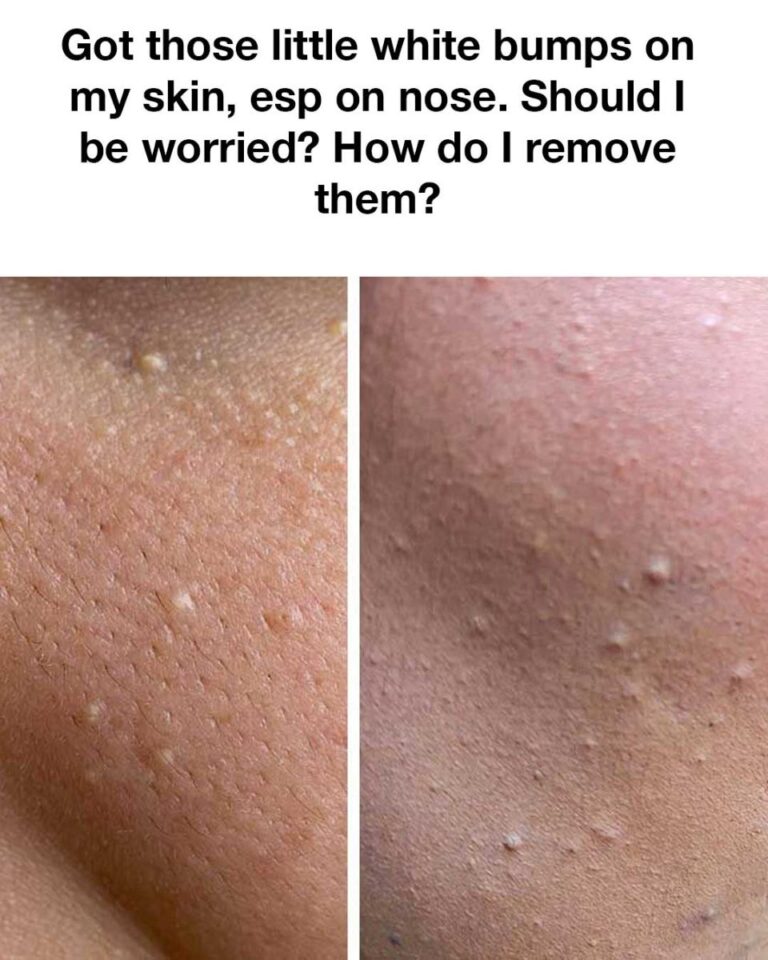 got these little bumps on my skin, esp on nose. should i be worries ...