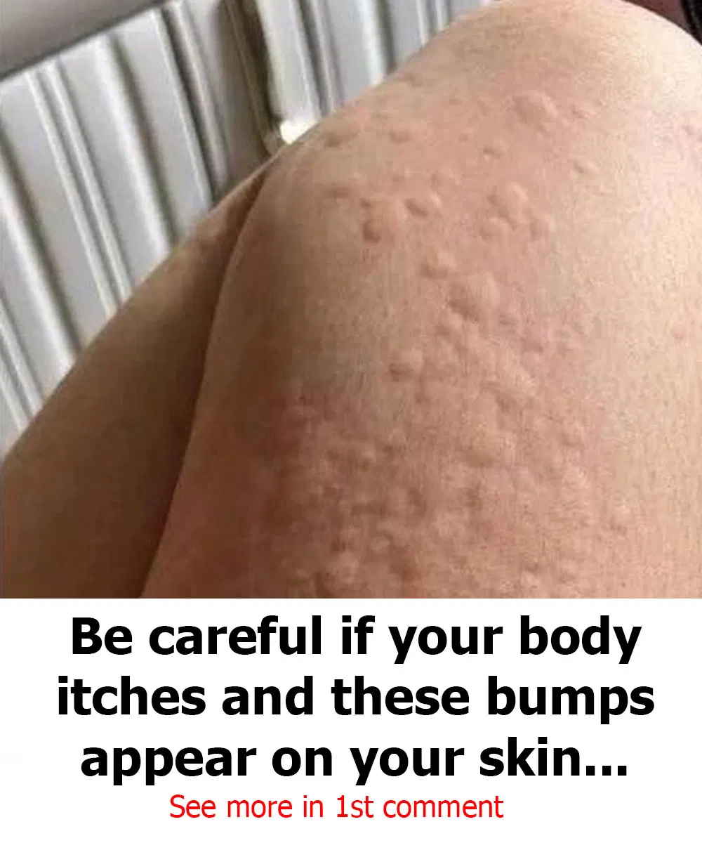 Why do hives appear on the skin? These are the surprising factors you ...